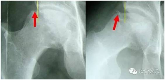 股骨头坏死的诊断与治疗要点 - 好医术早读文章 - 好医术-赋能医生守护生命