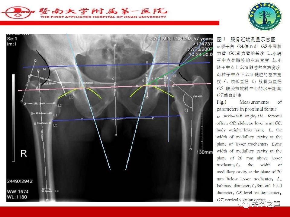 全髋关节置换的x线评估
