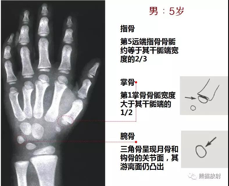 值得收藏的骨龄图谱!方便随时对照! 好医术早读文章 好医术 赋能医生守护生命