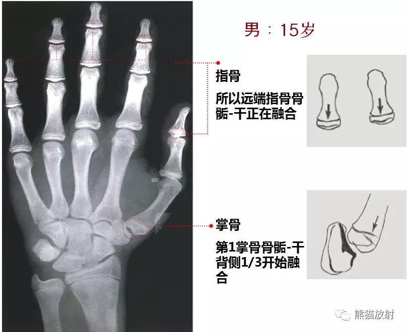值得收藏的骨龄图谱!方便随时对照! 好医术早读文章 好医术 赋能医生守护生命