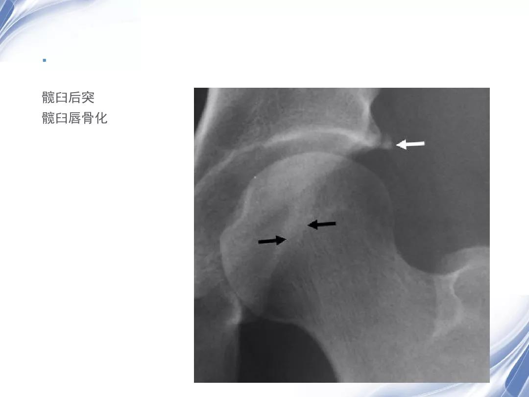 髋关节撞击综合征如何进行影像诊断？本文告诉你！ - 好医术早读文章 - 好医术-赋能医生守护生命