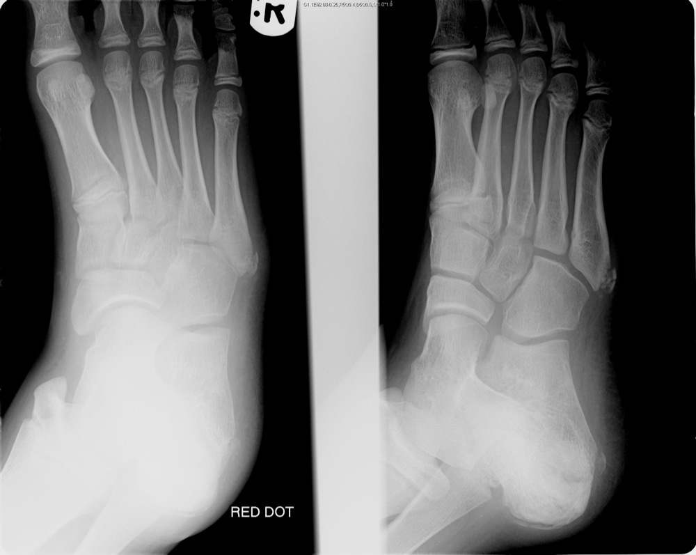 足部影像分析诊断，一文搞定！ - 好医术早读文章 - 好医术-赋能医生守护生命